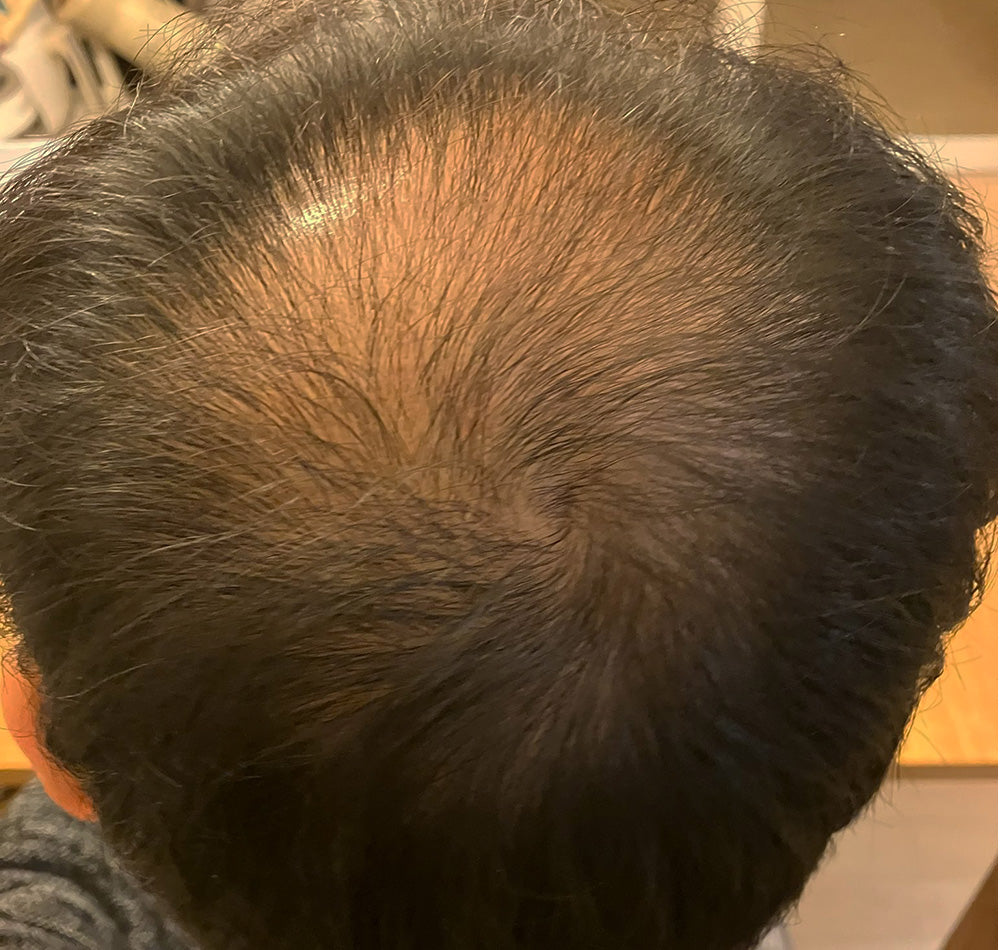 Ricrescita Capelli | Casco LED per la Ricrescita dei Capelli ...