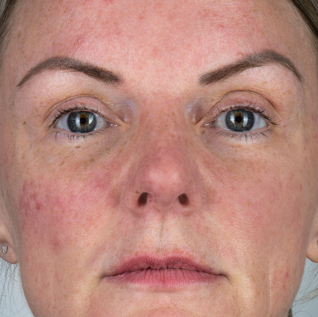 LED Face Mask | Red Light Therapy Masks | CurrentBody Skin UK