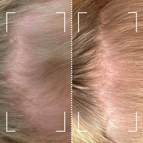 Red Light Therapy Hair Loss Helmet | Hair Growth Laser Cap | CurrentBody