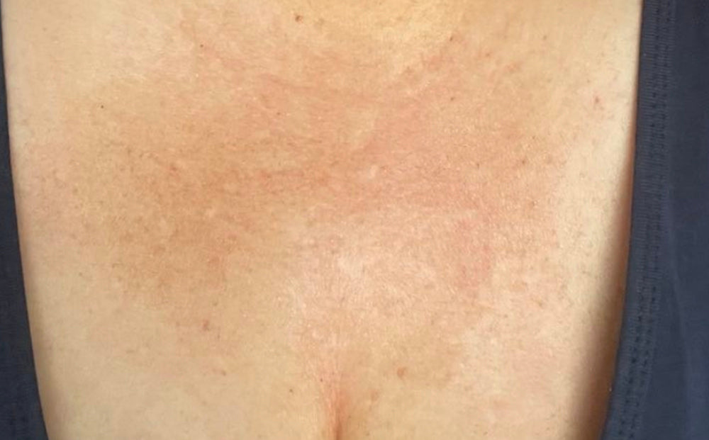 LED Neck and Dec Perfector | Chest Wrinkle Treatment | CurrentBody Skin