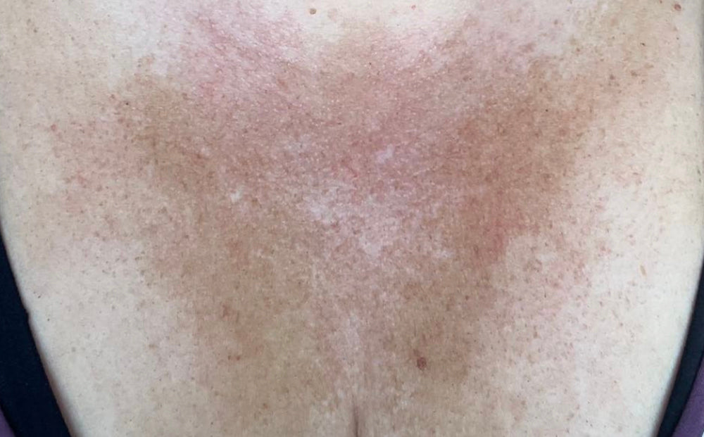 LED Neck and Dec Perfector | Chest Wrinkle Treatment | CurrentBody Skin