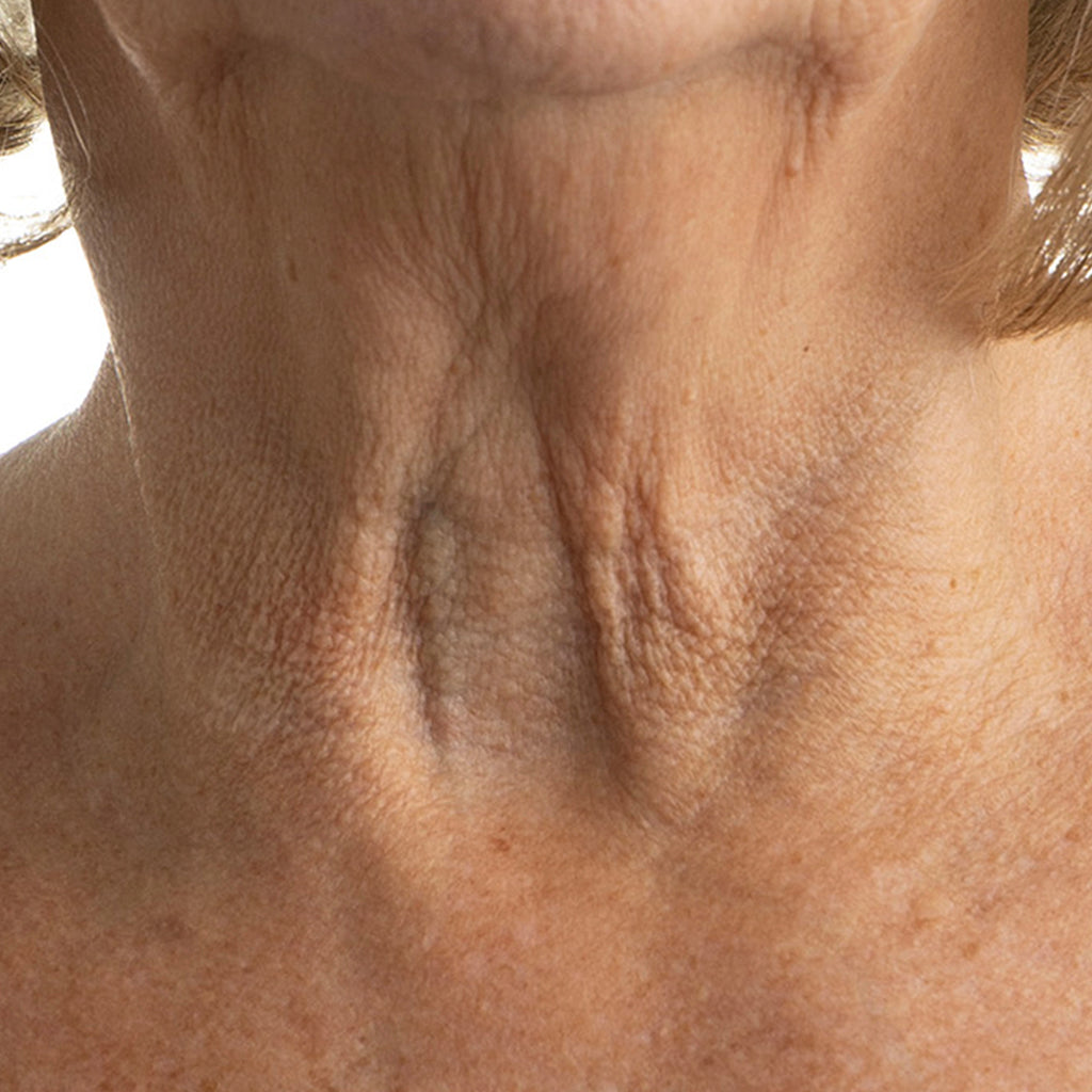 LED Neck and Dec Perfector | Chest Wrinkle Treatment | CurrentBody Skin