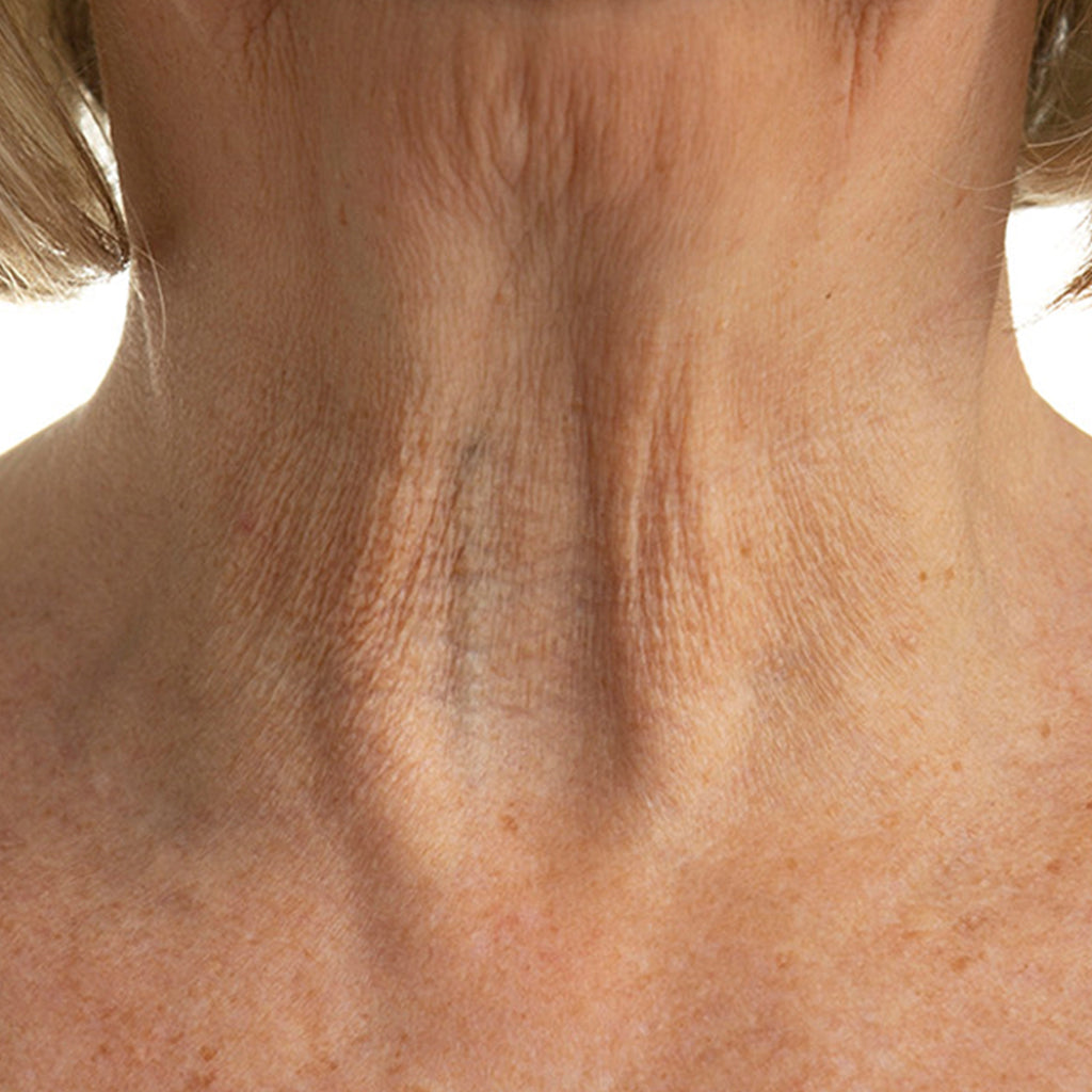LED Neck and Dec Perfector | Chest Wrinkle Treatment | CurrentBody Skin