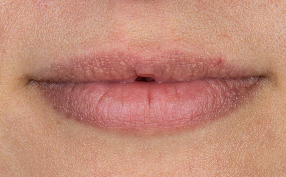 LED Lip Perfector | Lip Wrinkle & Volume Device | CurrentBody Skin